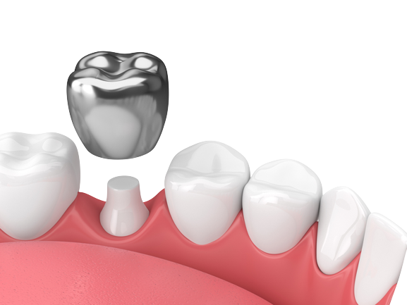 Stainless Steel Crowns
